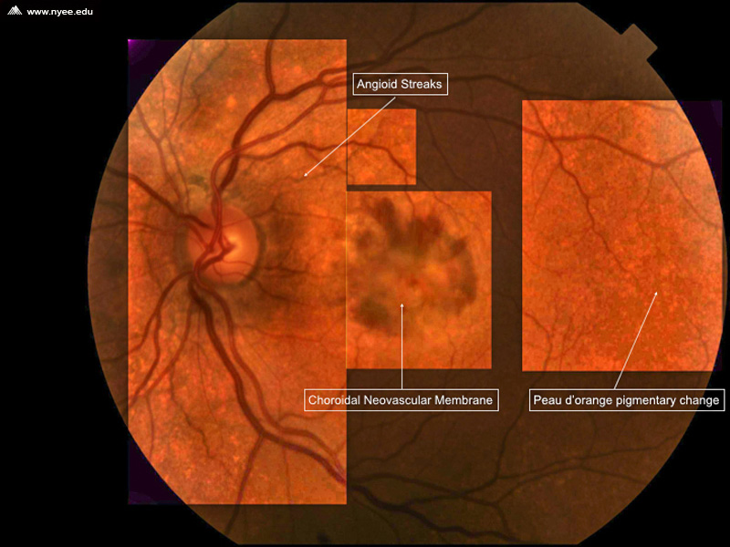 Angioid Streaks (18 of 19) - NYEE