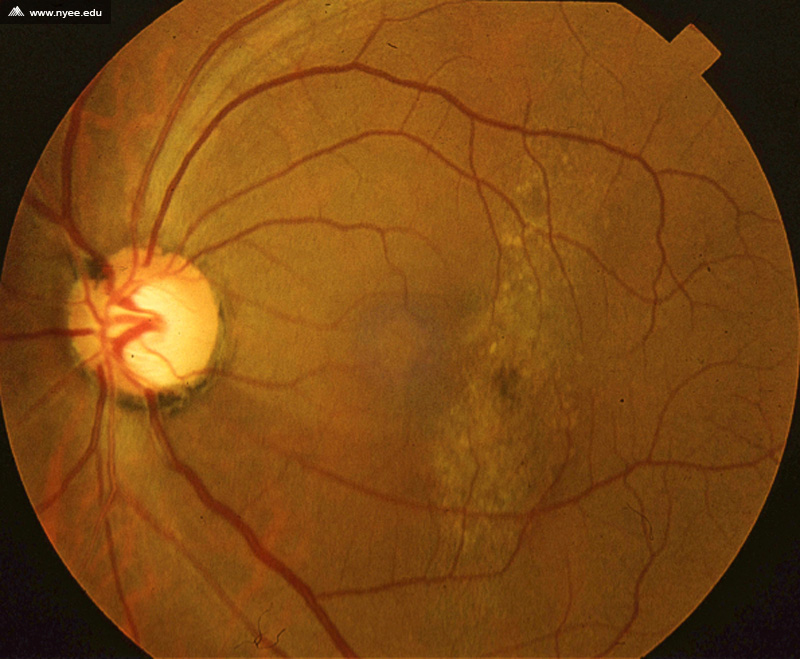 CSR Central Serous Retinopathy Chronic (7 of 10) - NYEE