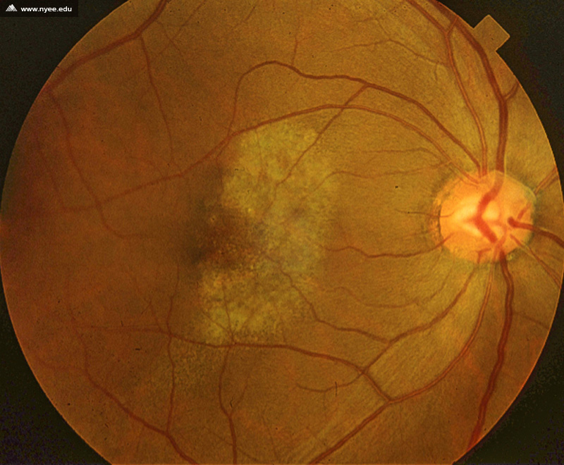 CSR Central Serous Retinopathy Chronic (8 of 10) - NYEE