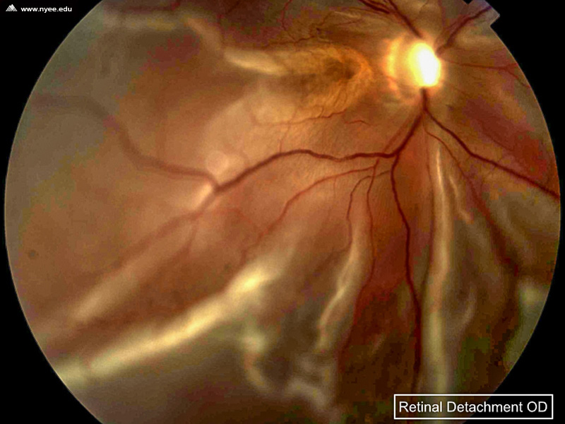 Chronic Retinal Detachment with Retinal Cyst (1 of 4) - NYEE
