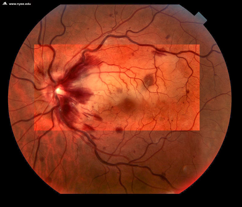 Central Retinal Vein Occlusion CRVO w Cilio Retinal Artery (15 of 17 ...