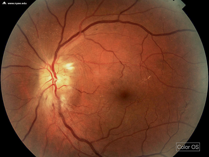 Malignant Hypertension Retinopathy (2 of 10) - NYEE