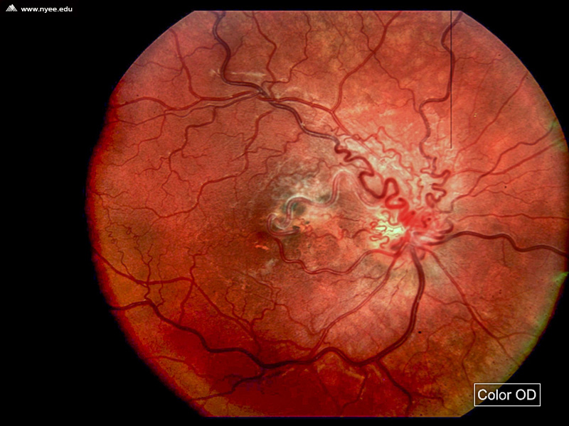 Racemous Hemangioma (1 of 7) - NYEE