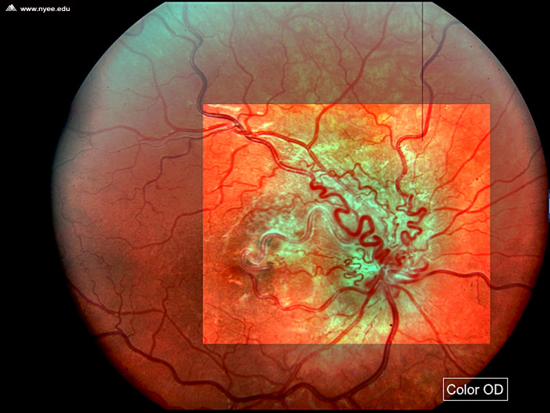 Racemous Hemangioma (2 of 7) - NYEE