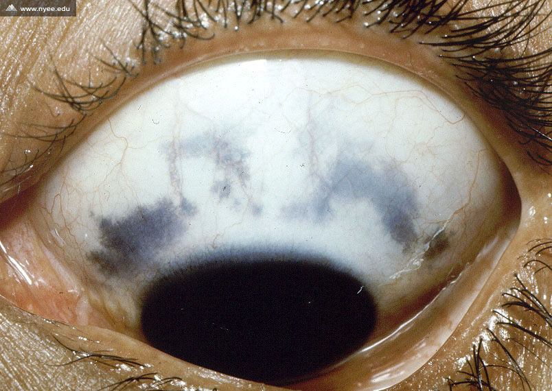 Nevus of Ota - NYEE