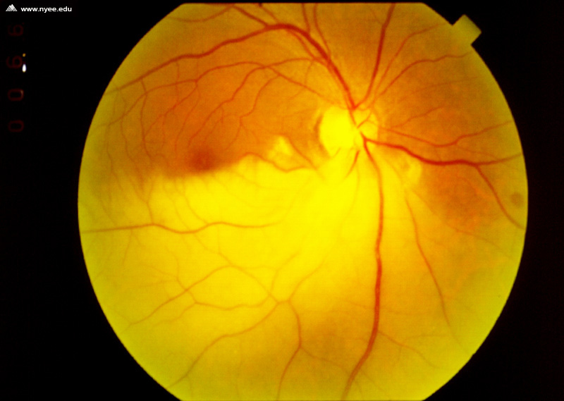Branch Retinal Artery Occlusion