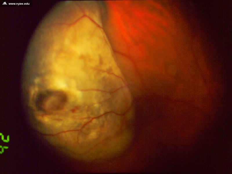 Choroidal Detachment - NYEE