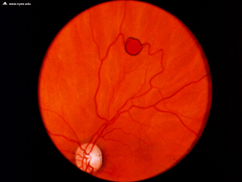 Retinal Angioma - NYEE