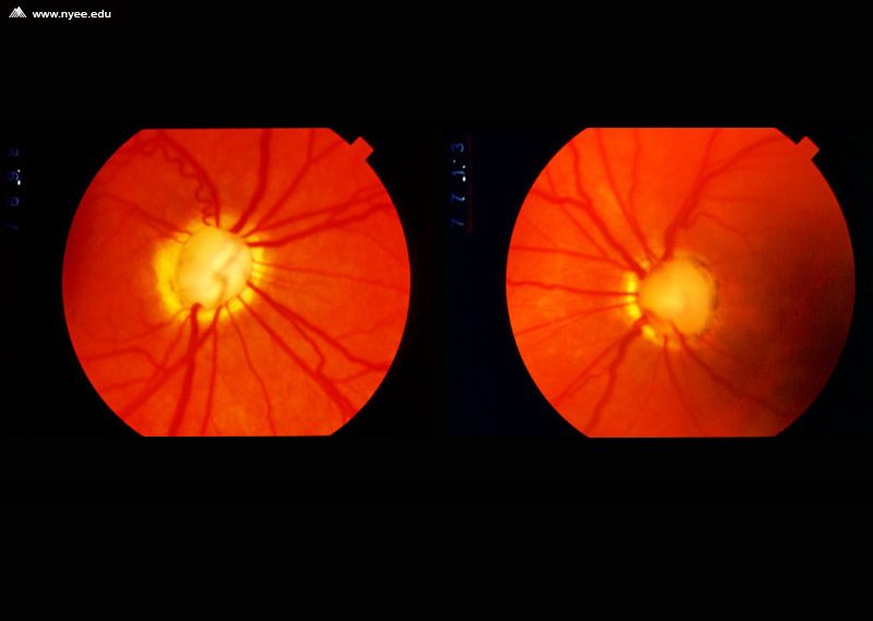 Anomalous Optic Nerve, Bilateral - NYEE