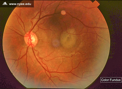 CSR Central Serous Retinopathy Chronic (1 of 10) - NYEE