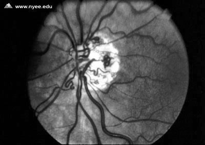 Optociliary Shunt Vessels - NYEE