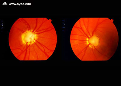 Anomalous Optic Nerve, Bilateral - NYEE
