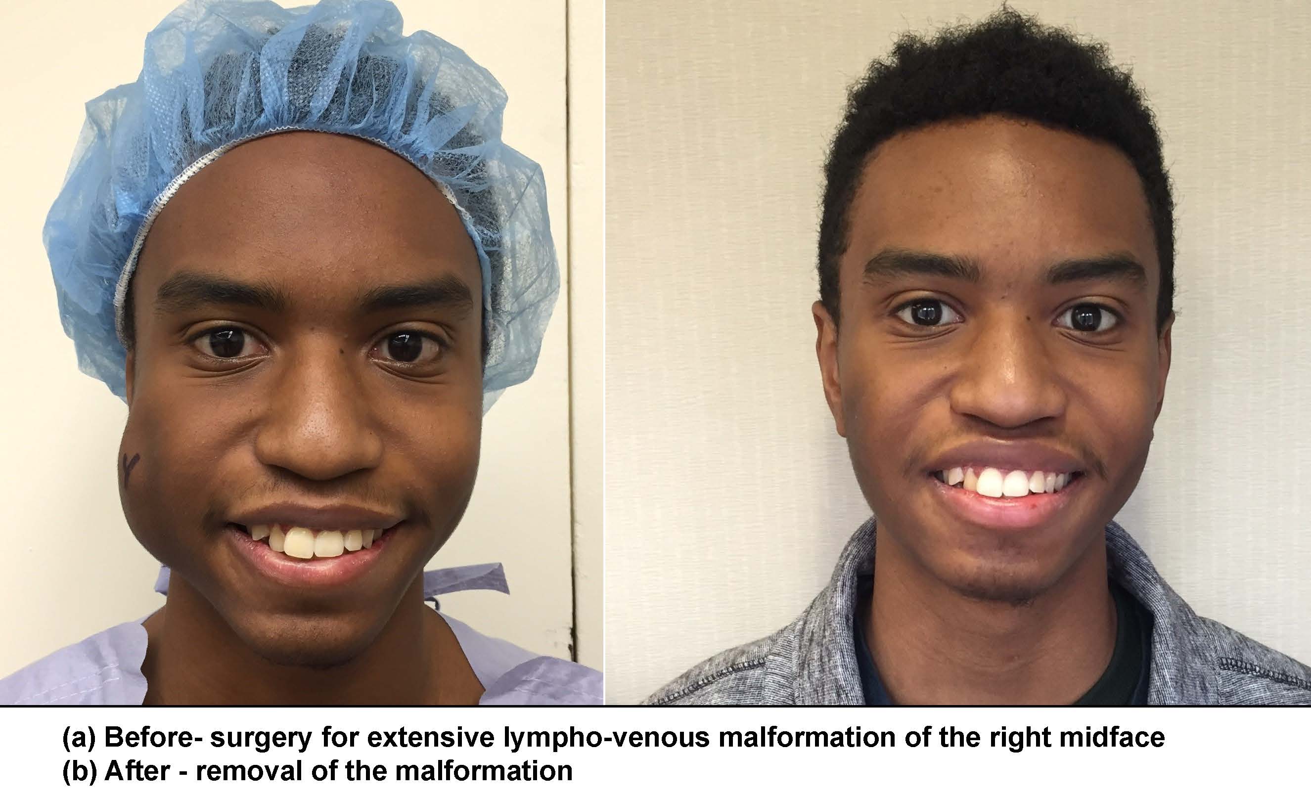 Lymphatic Malformations - NYEE