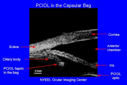 Intraocular Lens Position UBM Image - NYEE