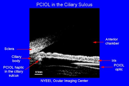 Intraocular Lens Position UBM Image - NYEE