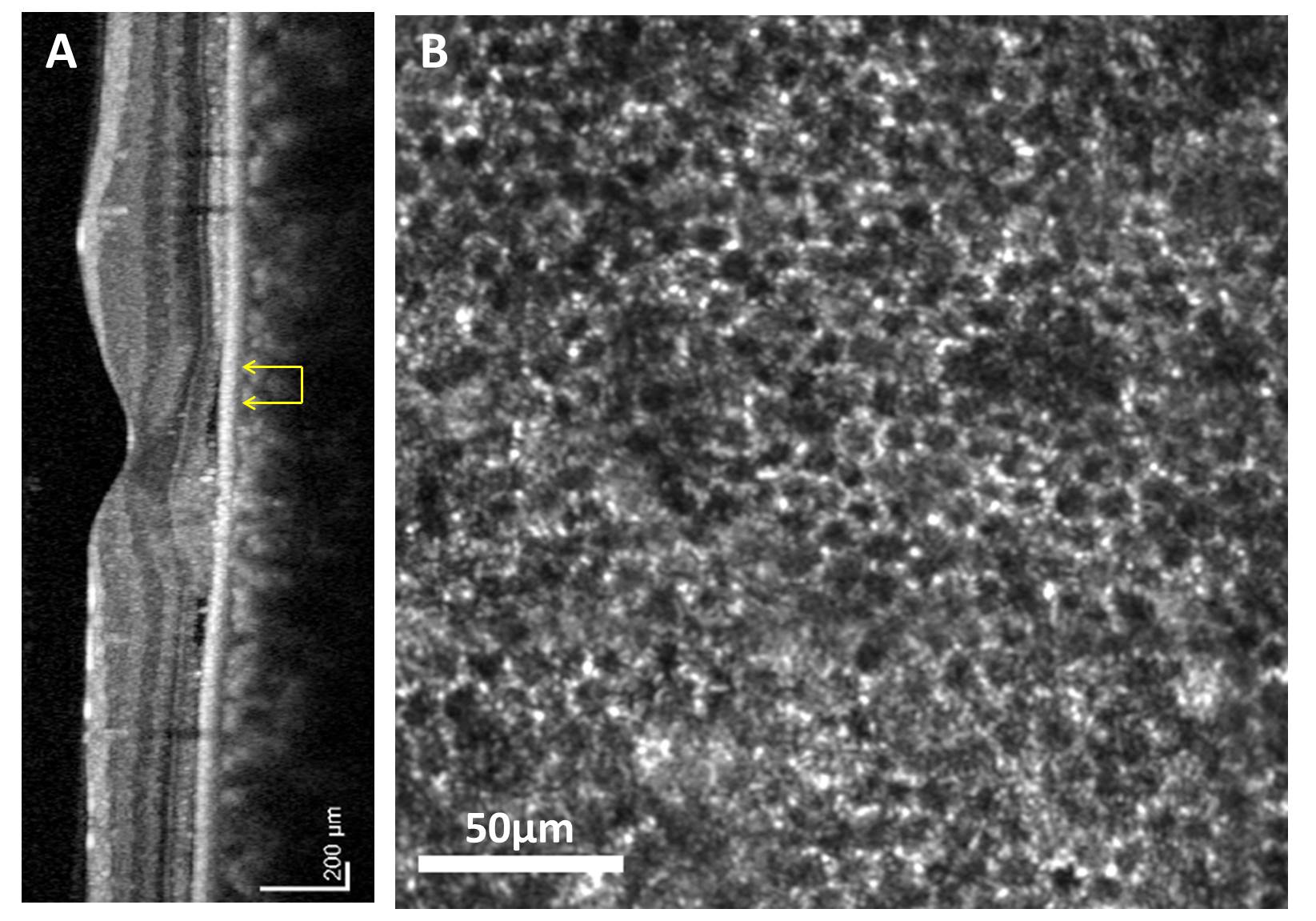 Retinal Pigment Epithelium - NYEE