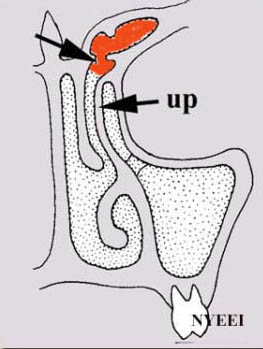 Frontal Sinusotomy - NYEE