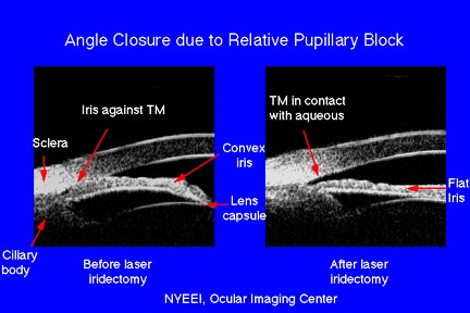 Angle-Closure Glaucomas UBM Image - NYEE