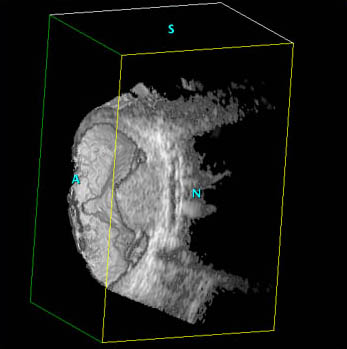 OTI Scan 1000 Ultrasound Tomography System - NYEE